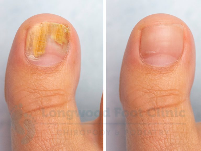 Fungal Nail Infection – Longwood Foot Clinic